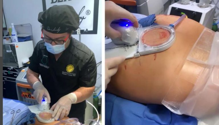 جهاز سيلفينا Cellfina لعلاج السليوليت بدون ألم l ما هي مزايا وعيوب جهاز ...